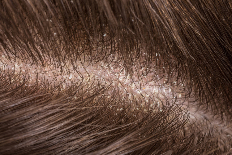 Different Scalp Conditions and their Treatments: What’s there to Know ...